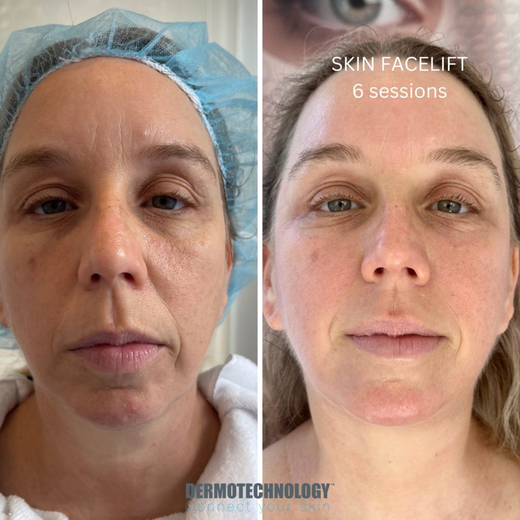 DERMOTECHNOLOGY Concept Microcurrent - Dermotechnology